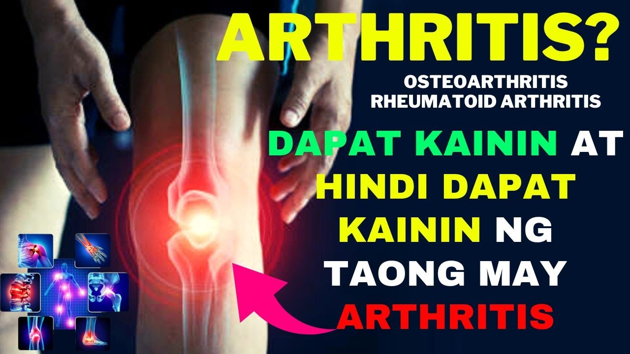 ARTHRITIS - Mga Maling Paniniwala at Mga DAPAT kainin at HINDI Dapat ...