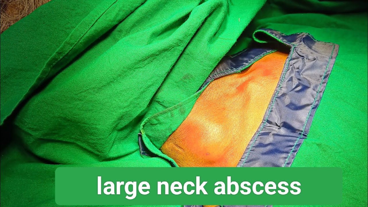 abscess | large neck tuberculous abscess | incision and drainage under ...