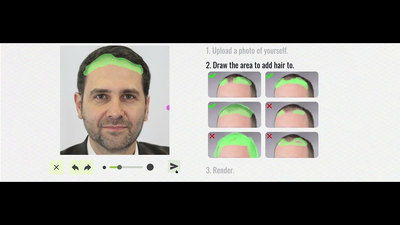 Hair Transplant Simulation Web Widget - YouTube