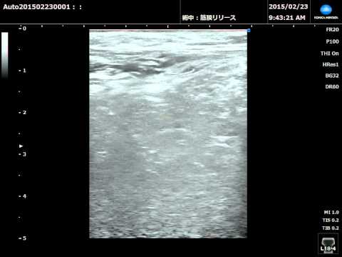 anococcygeal body 01 - YouTube