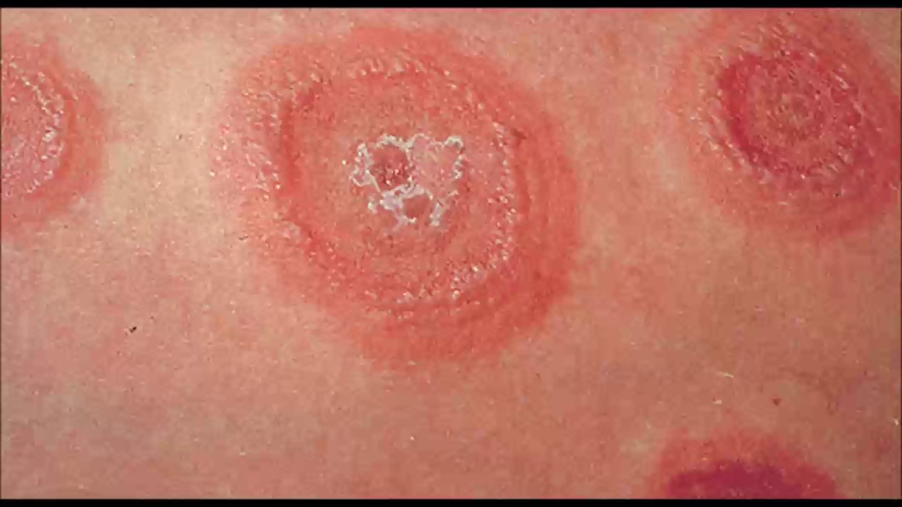 Erythème infectieux - YouTube