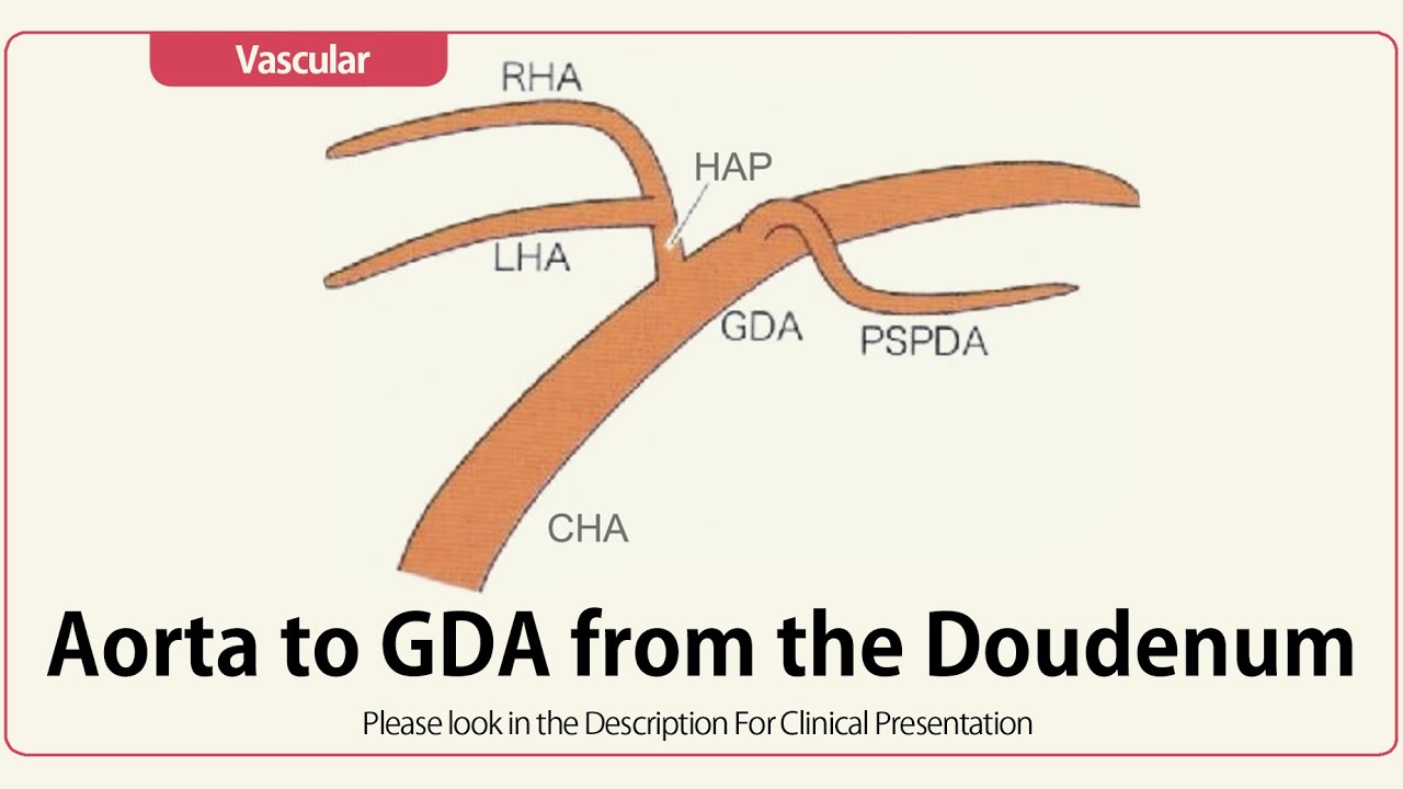 Aorta to GDA from Duodenum - YouTube