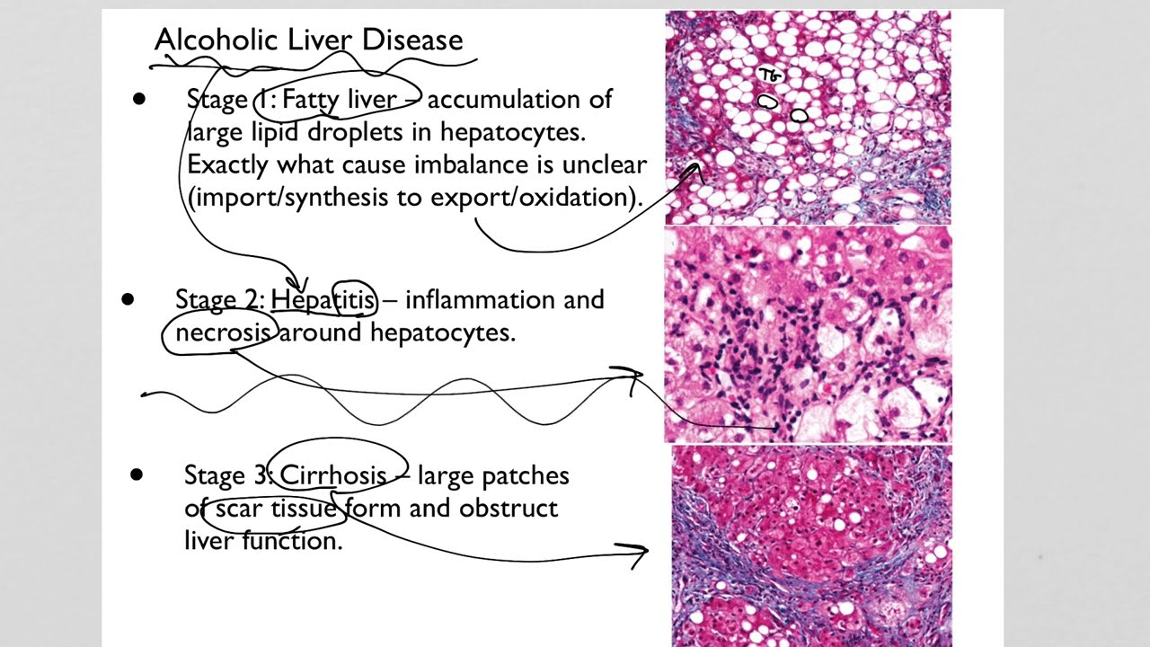 Liver Disease: Alcohol and Fructose Metabolism - YouTube