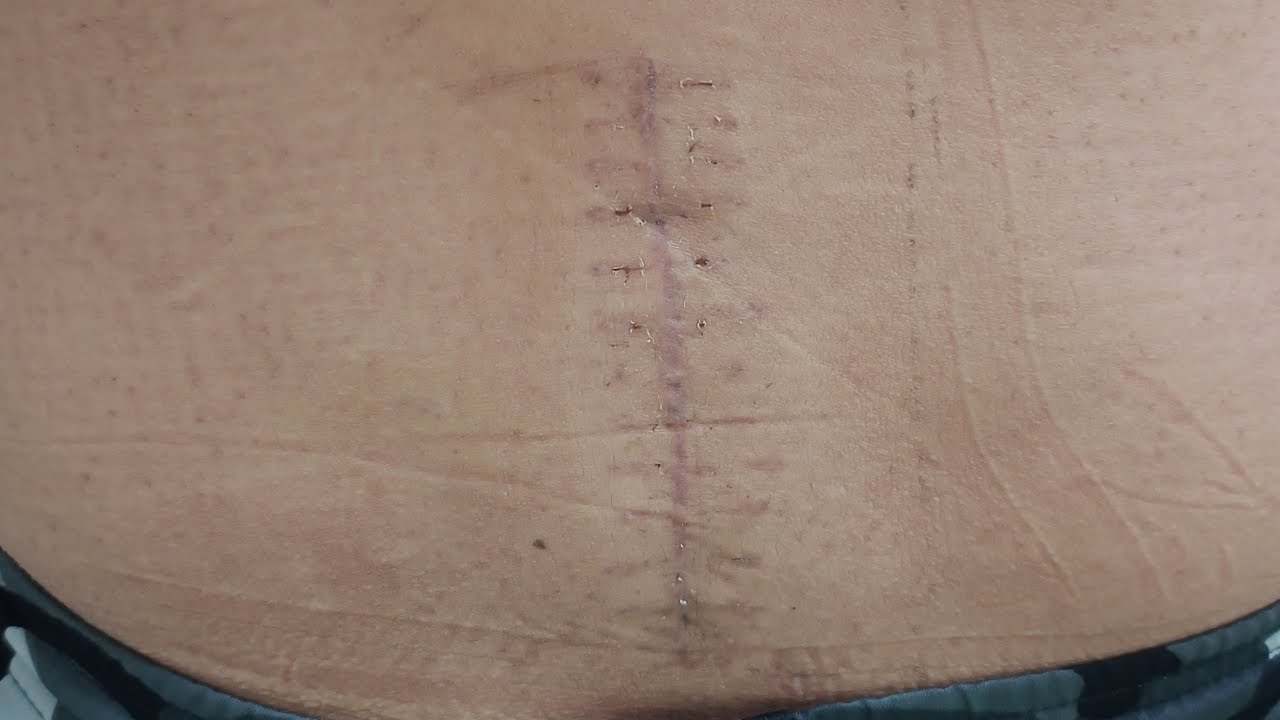 L4 L5 S1 Disc bulge,Disc decompression, Rod implant In Disc , Disc ...