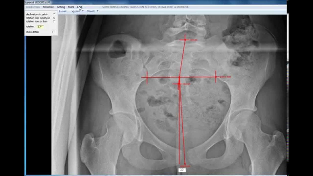 Measurement of axial pelvis rotation by program AngleSpine. - YouTube