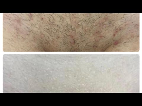 Laser tattoo removal bikini