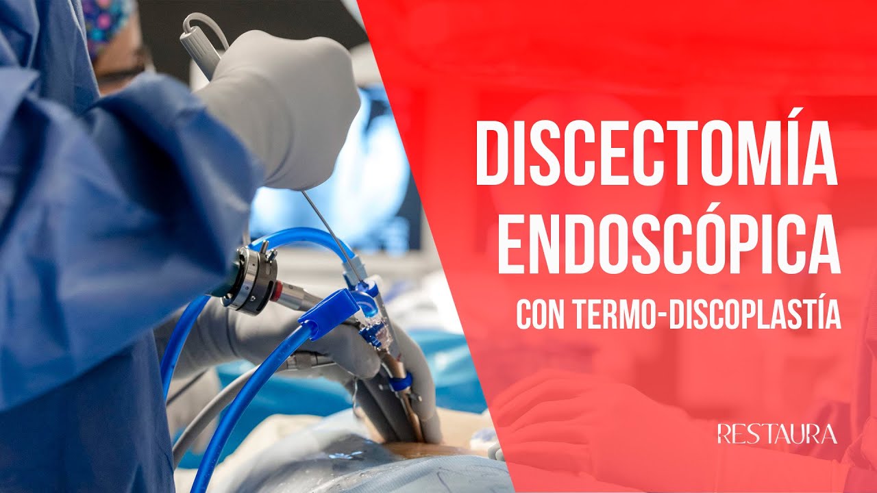 Discectomía endoscópica con termodiscoplastía para hernia de disco y ruptura discal ...