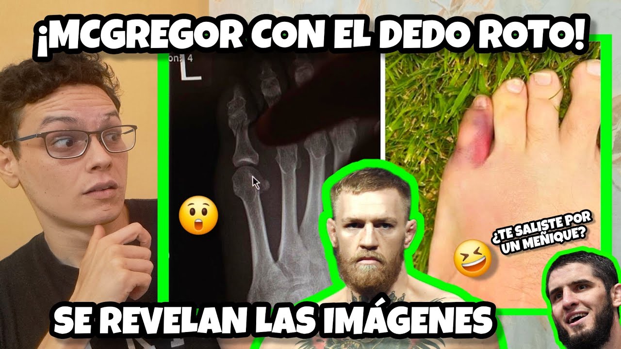 DEDO ROTO de CONOR MCGREGOR‼️ imágenes de la lesión😵 - YouTube