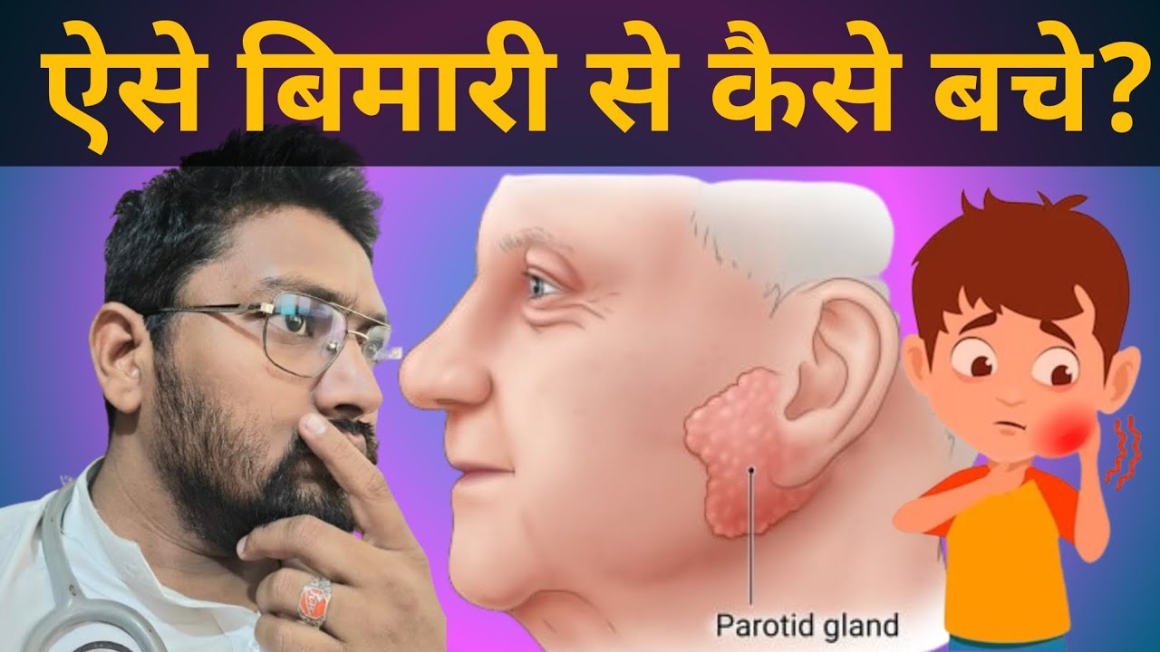 Mumps Disease & It's Treatment In Hindi || गलसूआ का इलाज ||Dr Devidas Patil - YouTube