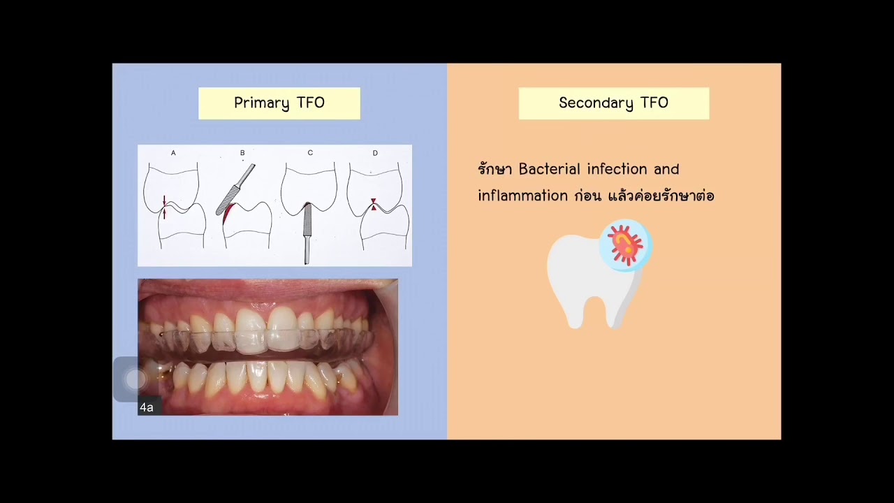 Trauma From Occlusion (Dent KKU) - YouTube