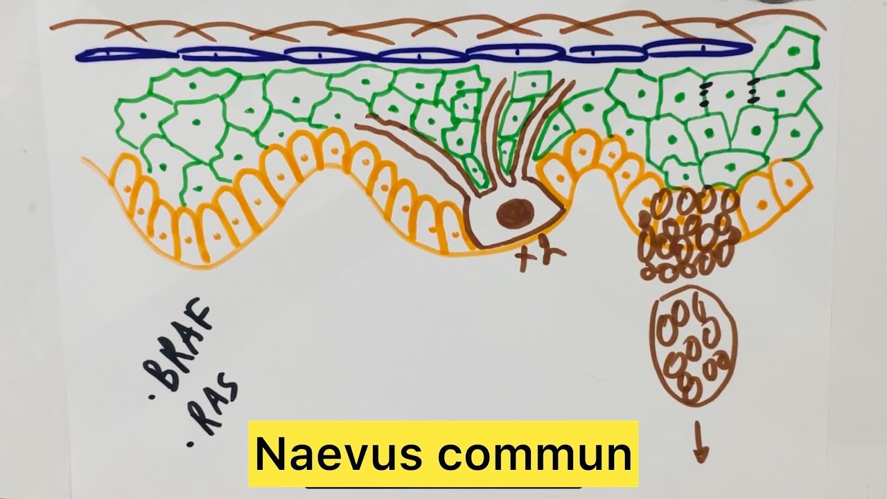 Naevus commun - YouTube
