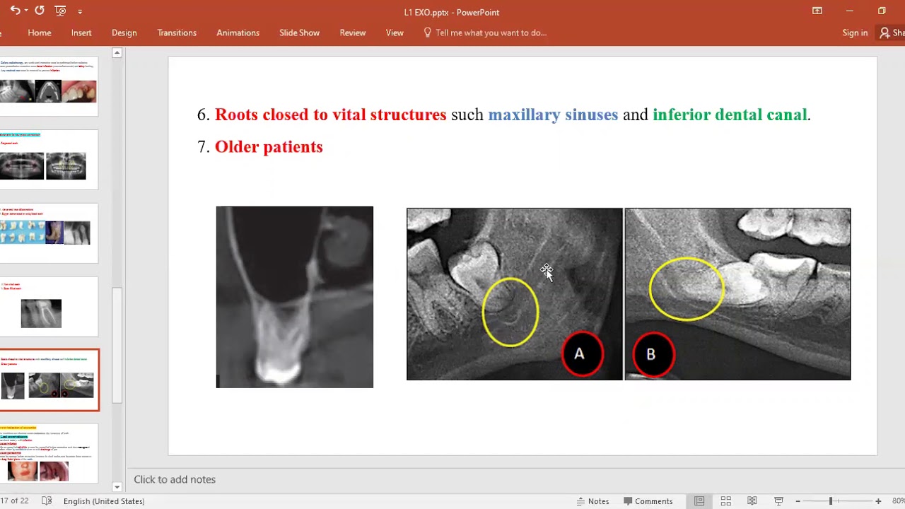 Oral Surgery Exodontia lec2 - YouTube