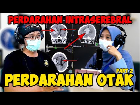 Perdarahan Otak Part 2 | #PKUTALK