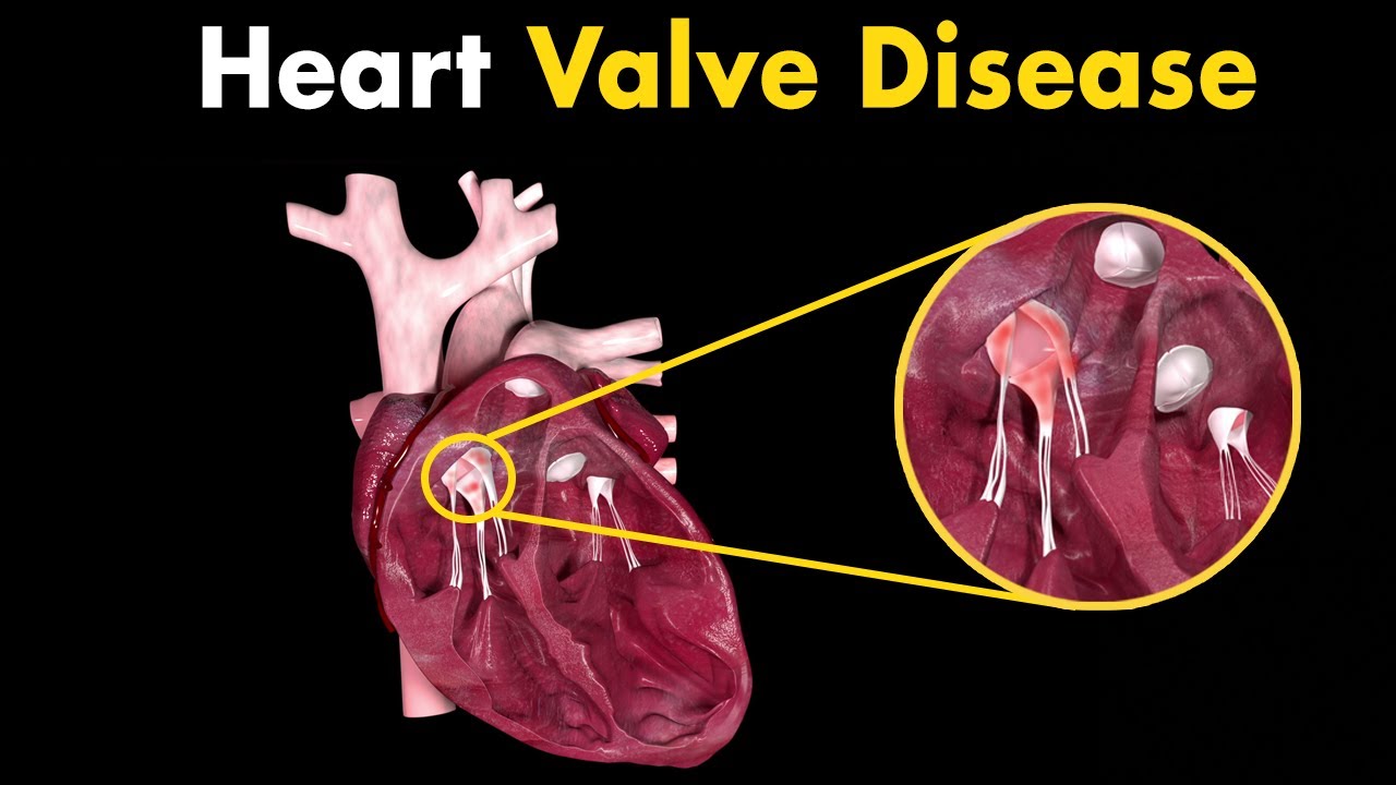 how heart valve disease occurs?Symptoms , Diagnosis and Treatment - YouTube