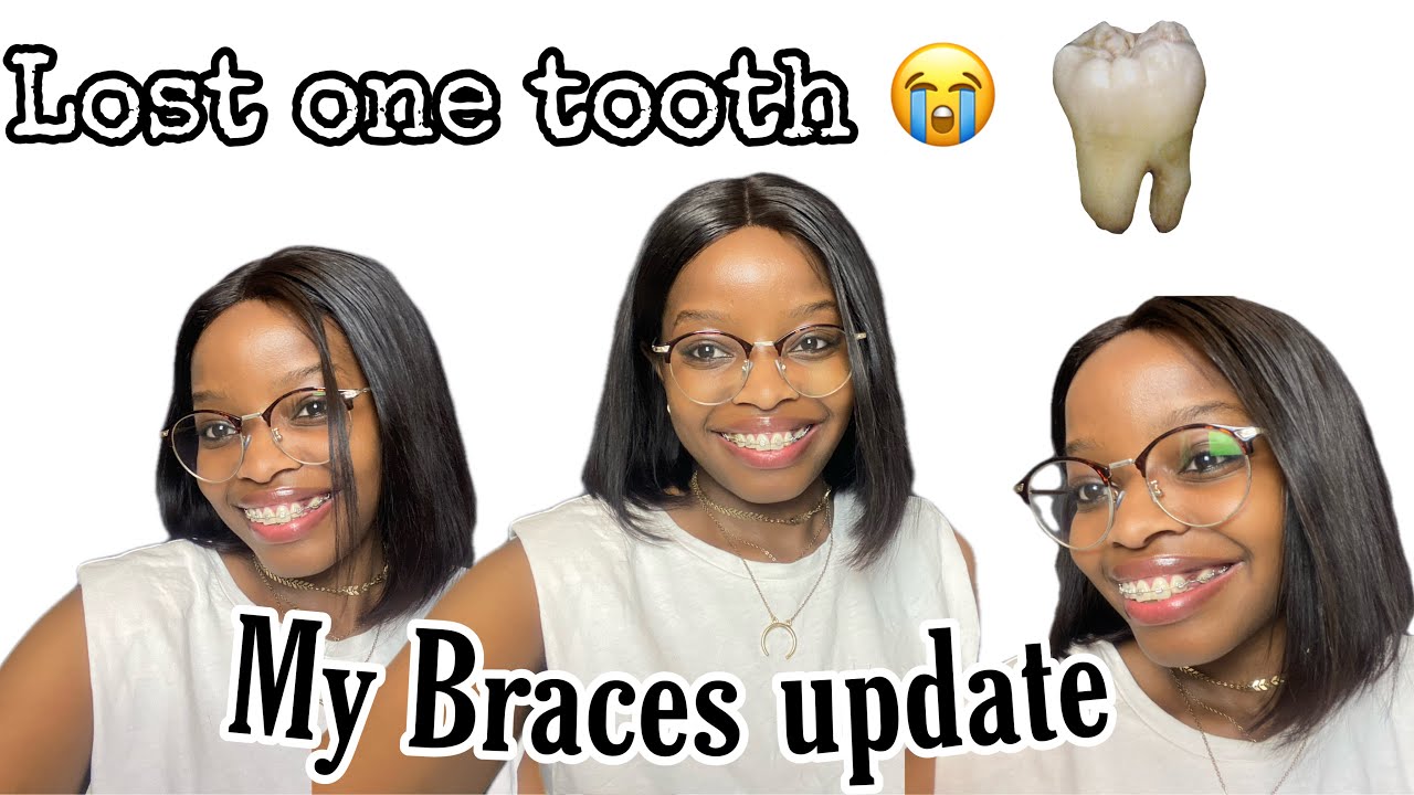 1 Month Braces Update [tooth Extraction First Braces Tightening