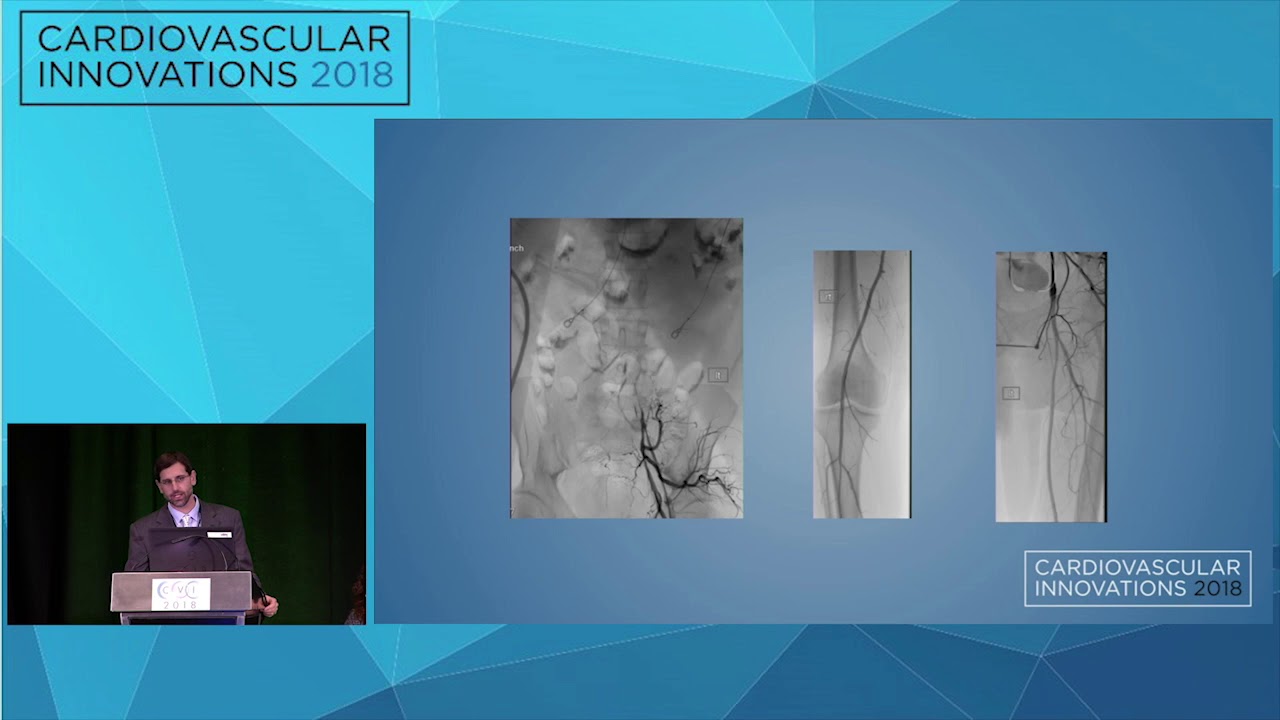 CVI2018 Session: My worst aortoiliac complication - Christopher Huff ...