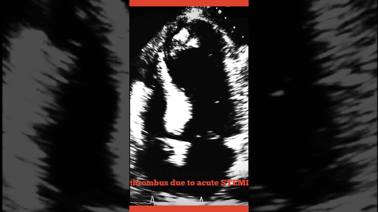 LV Apical Aneurysm with thrombus due to acute STEMI - YouTube