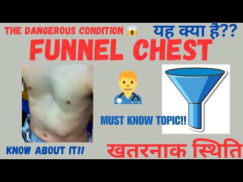 Unveiling the Mystery: Diagnosing Funnel Chest फ़नल चेस्ट डायग्नोसिस के ...