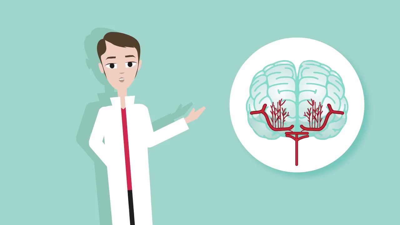 cartoon 1 : AIC (AVC Ischémique ou Infarctus Cérébral) - YouTube