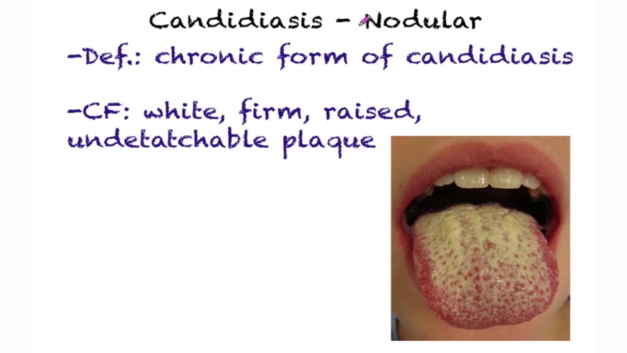 White Lesions: Candidiasis - YouTube