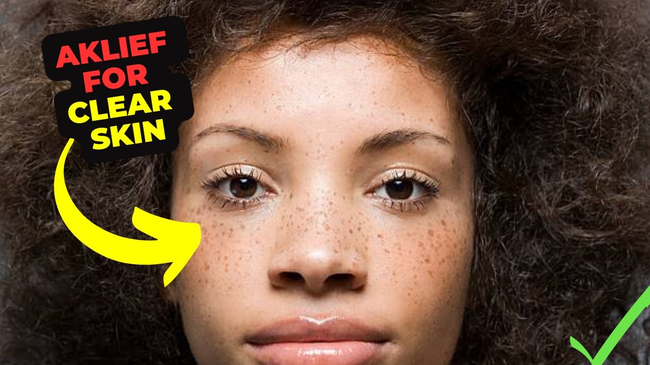 Aklief Medication: Transforming Lives with Clear Skin and Confidence ...