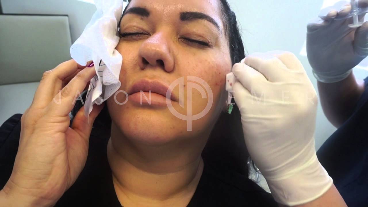 Radiesse Soft Tissue Filler Cheek Augmentation / Filler to Cheeks / Non ...