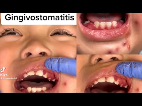 Can Herpangina Cause Bleeding Gums In Toddlers