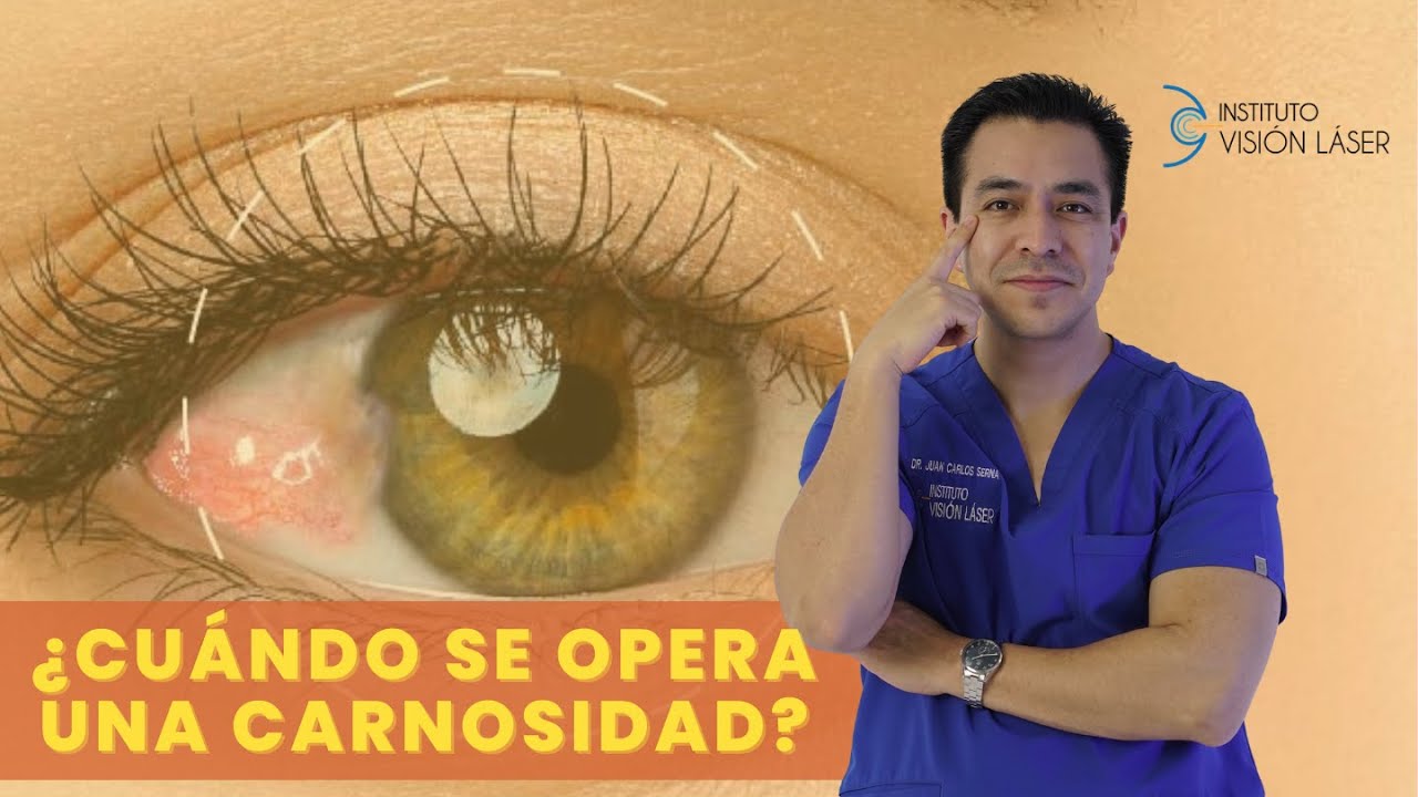 ¿CUÁNDO SE OPERA UNA CARNOSIDAD? - YouTube