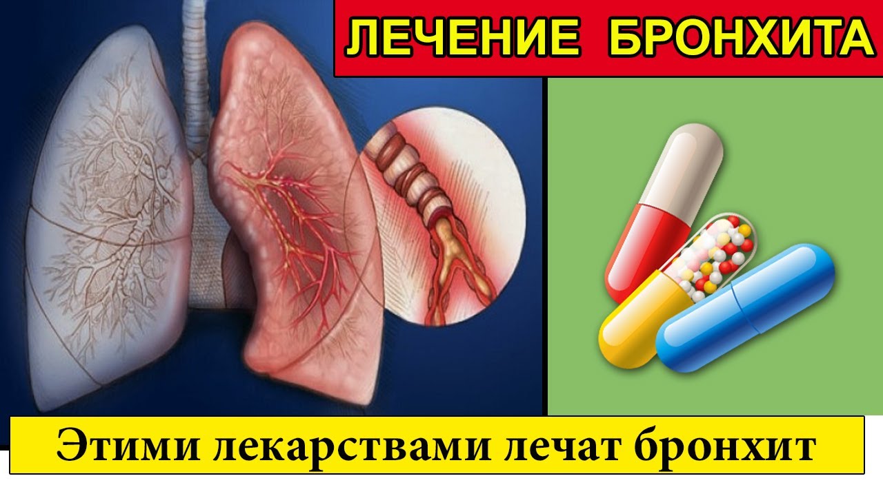 ЛЕЧЕНИЕ БРОНХИТА У ВЗРОСЛЫХ | Средство от бронхита | Как лечить бронхит ...