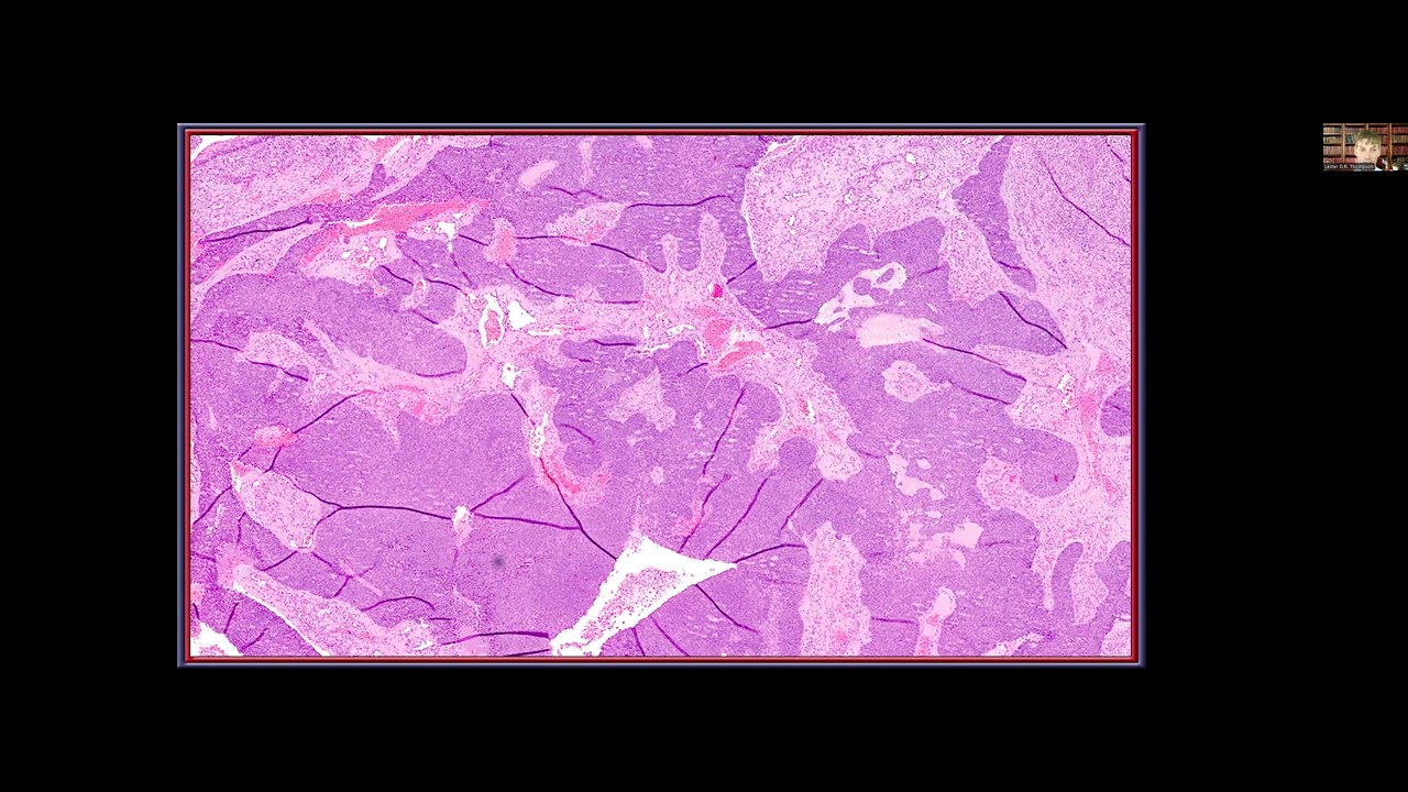 2022 07 25 Differentials for Small Round Blue Cell Tumors of the ...