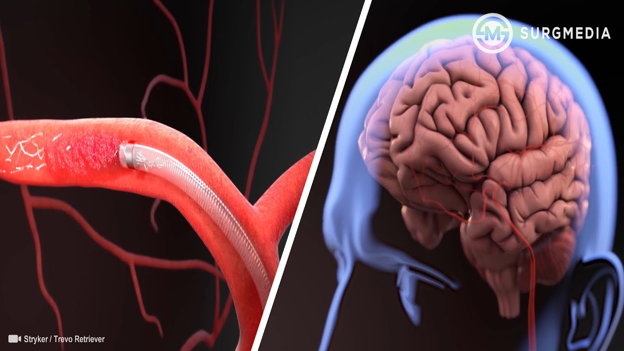 Percutaneous Clot Removal in Acute Ischemic Stroke | Stroke Recovery Tips Percutaneous Clot Removal in Acute Ischemic Stroke | Stroke Recovery Tips