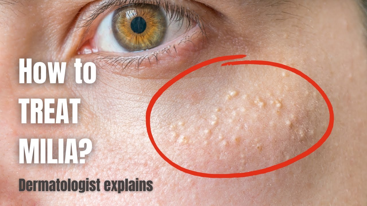 What Causes Milia Around Mouth Infoupdate what-causes-milia-around-mouth-infoupdate