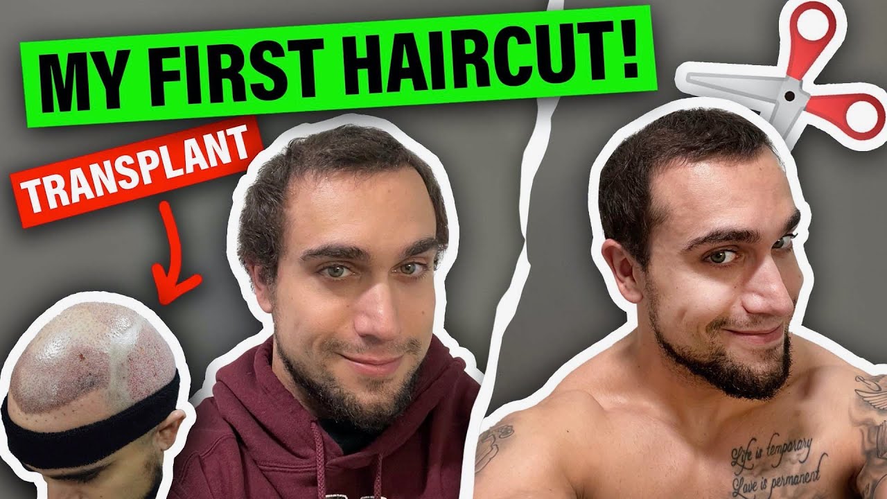 5 Months After My FUE Hair Transplant in Istanbul Turkey | First ...