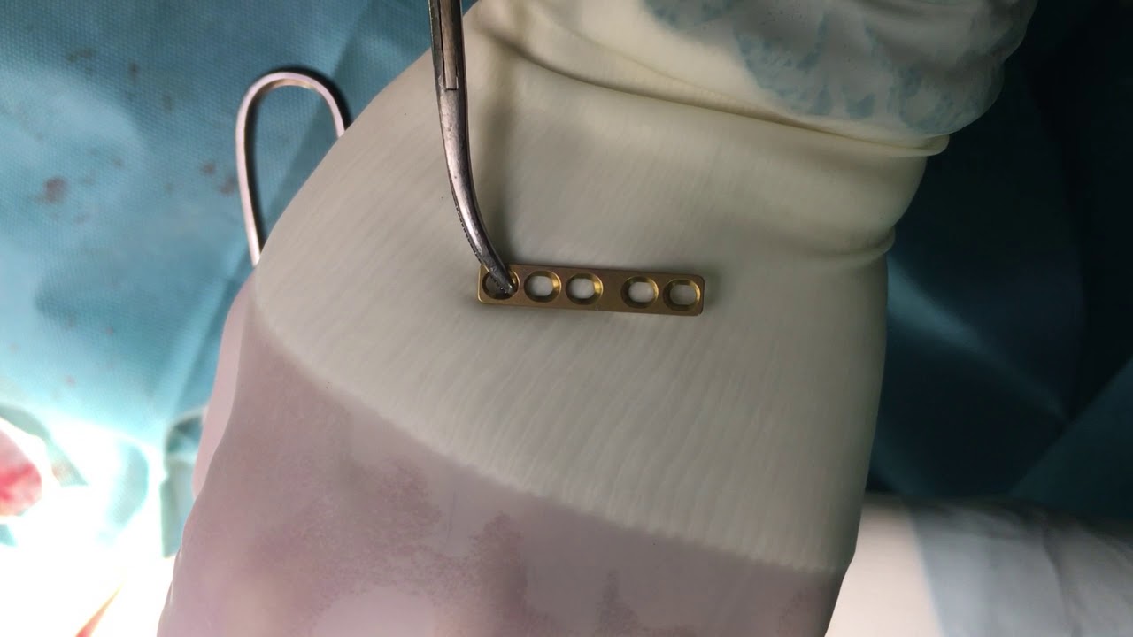 retromandibular transparotid approach to the condyle - YouTube