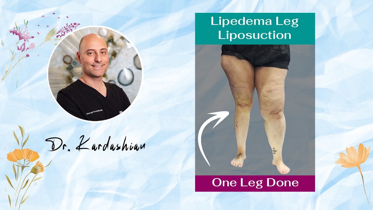 “That Looks Like a Totally Different Leg!” 360 Cankle & Knee Lipedema ...