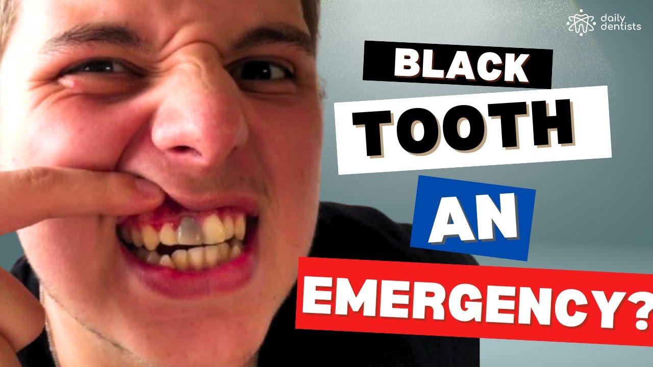 What is a Black Tooth? Is it an Emergency? Daily Dentists Explains ...