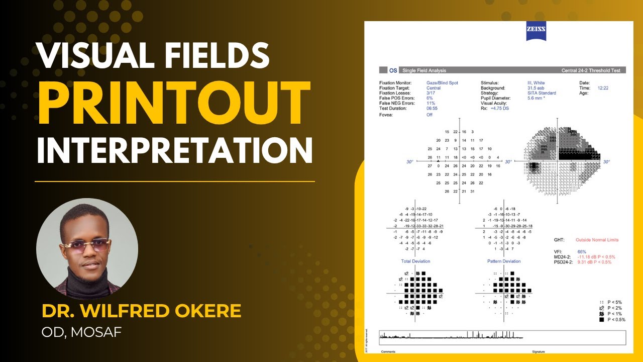 Visual Field Printout Interpretation | Full Tutorial on CVF Analysis ...