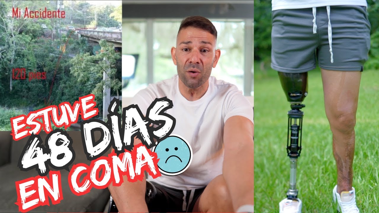 Me Amputaron Una Pierna y Cómo Reaccione Cuando Desperté 48 Días En ...