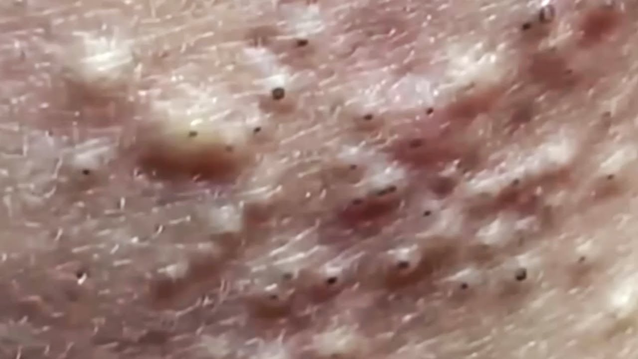 Satisfying Acne and Pimple Removal Blackheads & Whiteheads #1424 - YouTube