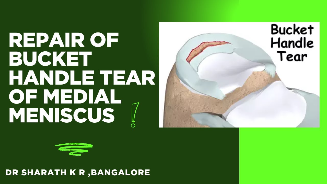 REPAIR OF BUCKET HANDLE TEAR OF MEDIAL MENISCUS - HOW IT IS PERFORMED ...