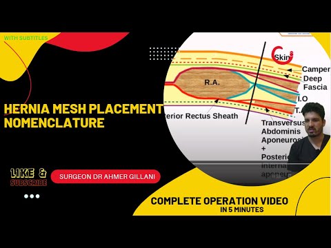 Ventral hernia surgery Planes for mesh placement Terminology SIMPLIFIED ...