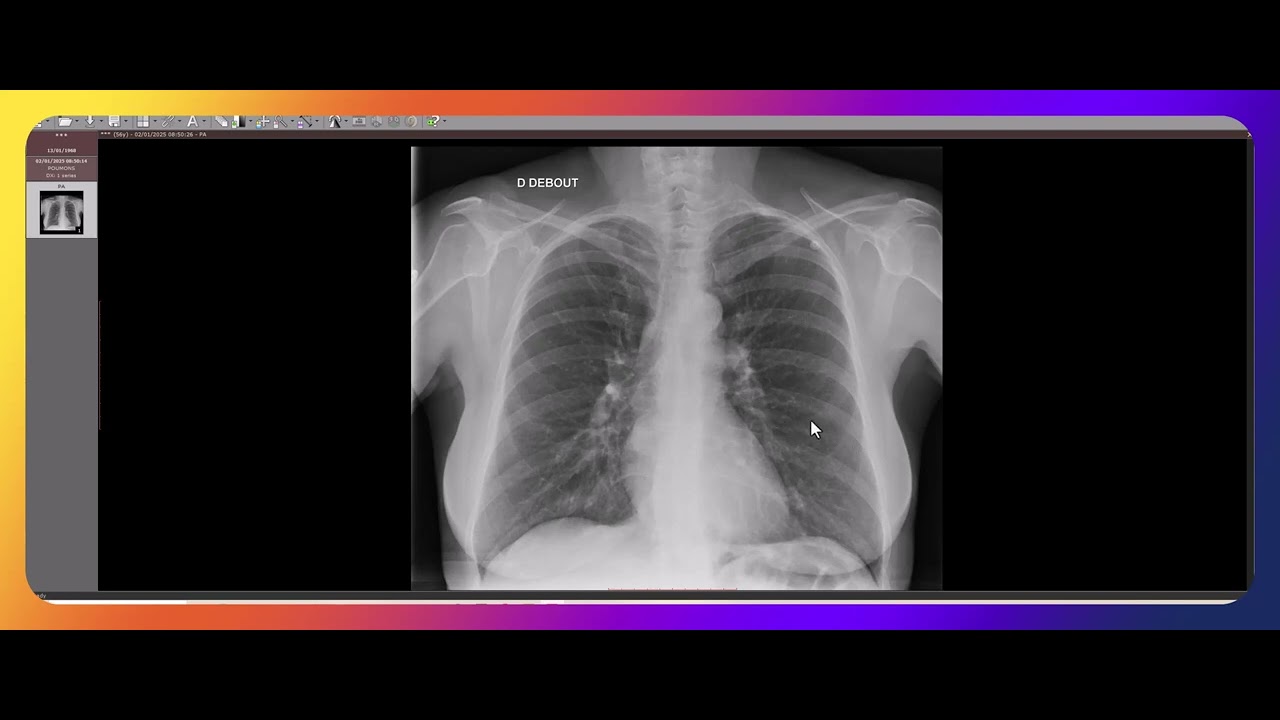Comment interpréter une radio pulmonaire ? - YouTube