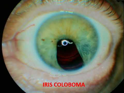 corneal scars and iris coloboma images explained - YouTube