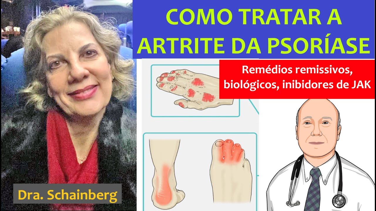 As diversas formas da artrite psoriásica. Tratamento da artrite da ...