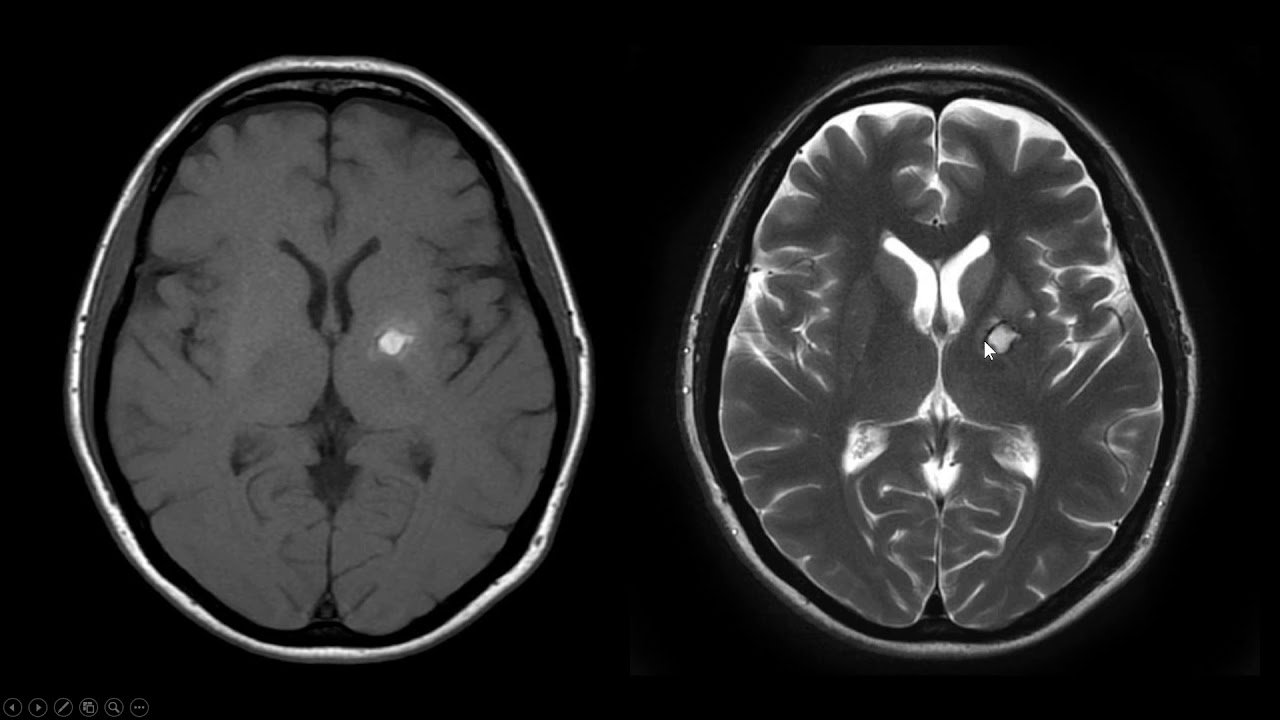 Ressonancia Magnetica De Acidente Vascular Cerebral Isquemico Vs ...