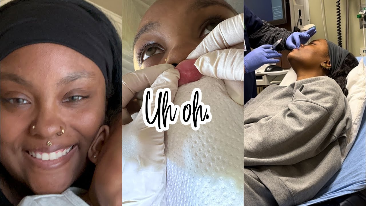 getting my embedded medusa piercing removed 😳 - YouTube