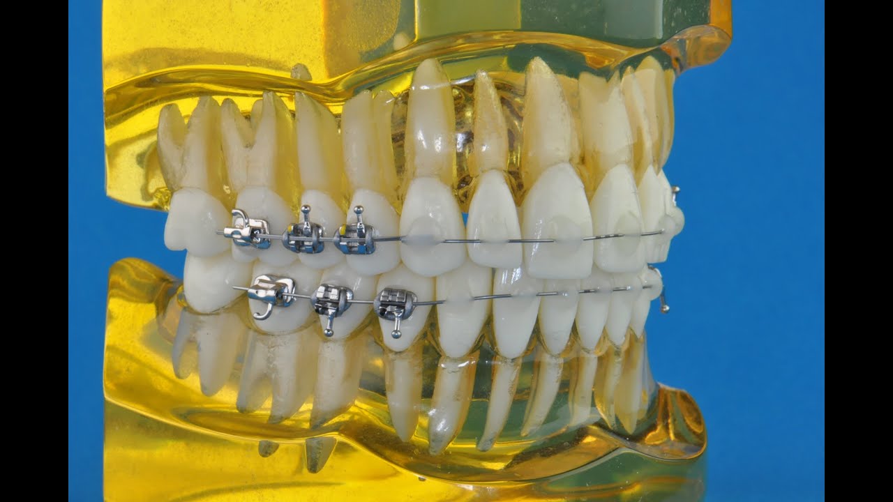 20210309 bracket free segmented arch - YouTube