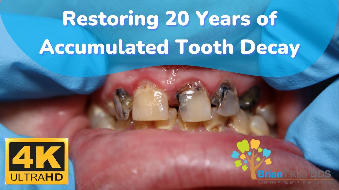 Restoring 20 years of Accumulated Tooth Decay (Part 1) - YouTube