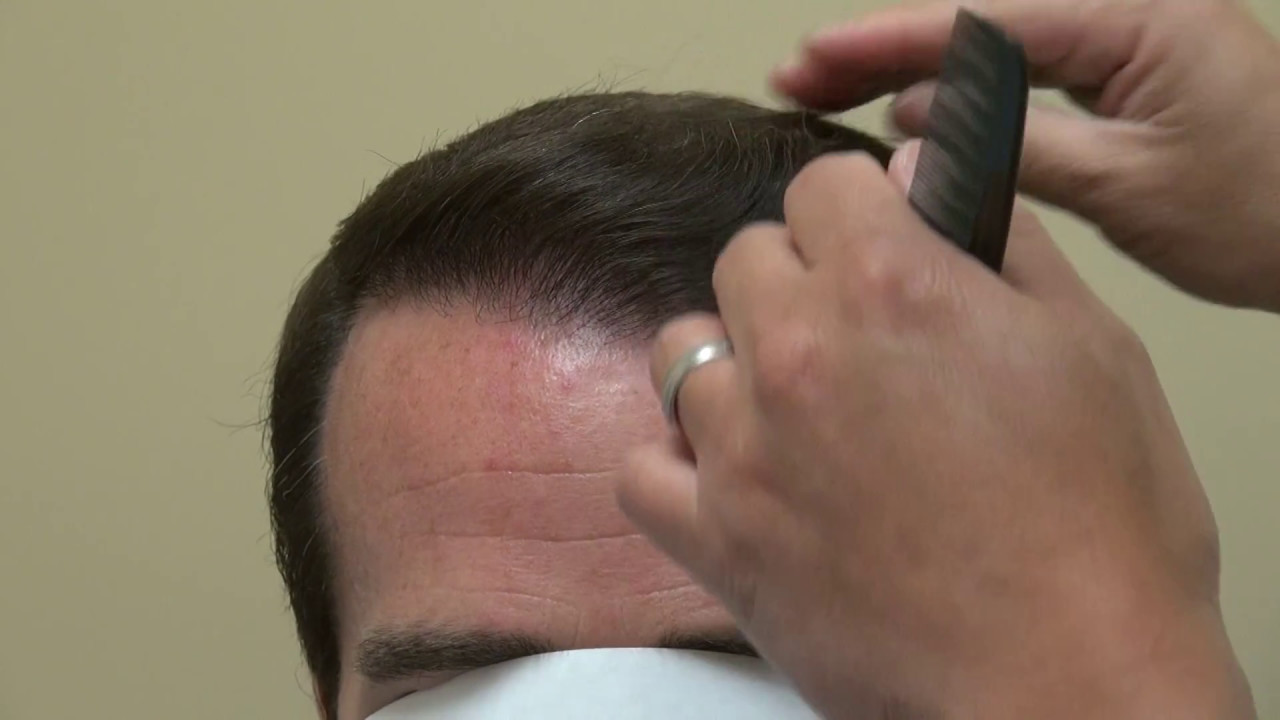 Caucasian Receding Hairline Surgery Results by Dr. Diep http://www ...