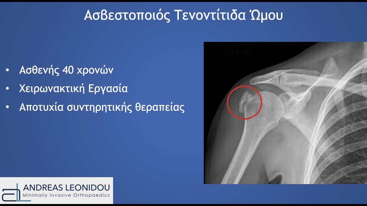 Ασβεστοποιός τενοντίτιδα - αρθροσκόπηση ώμου - YouTube